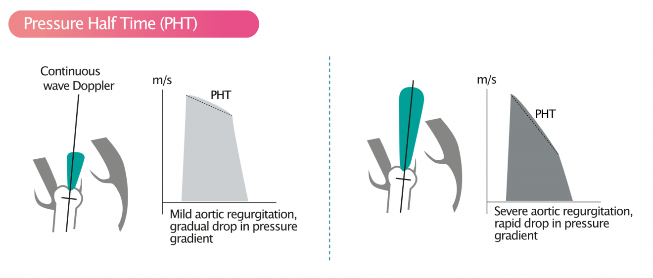 Aortic regurgitation - Echocardiography, diagnosis, grading, severity