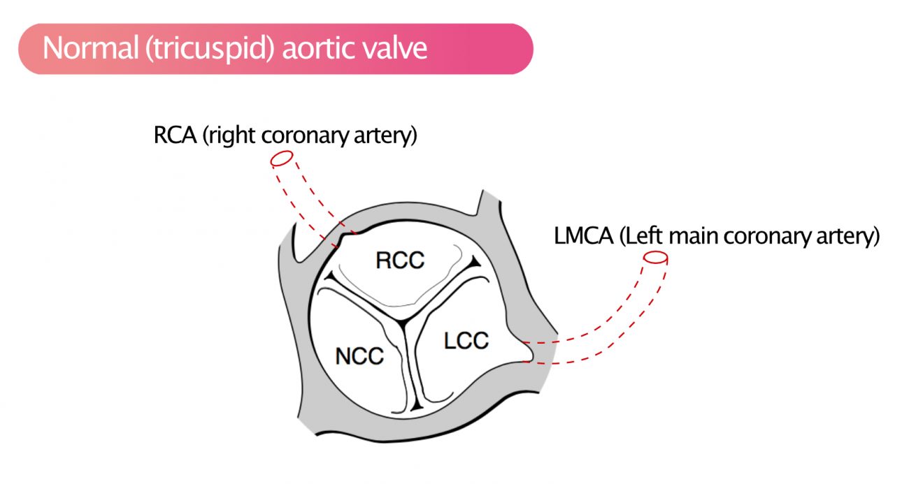 Aortic stenosis - Echocardiography, diagnosis, grading, causes, management