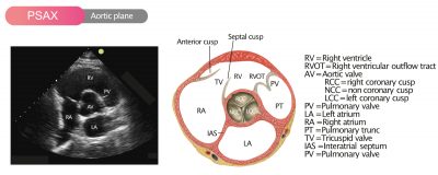 Aortic valve stenosis – ECG & ECHO