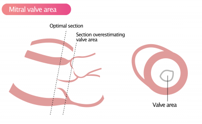Mitral valve stenosis - Echocardiography, diagnosis, causes, severity