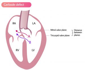 Congenital heart disease & GUCH (Grown Up Congenital Heart disease ...