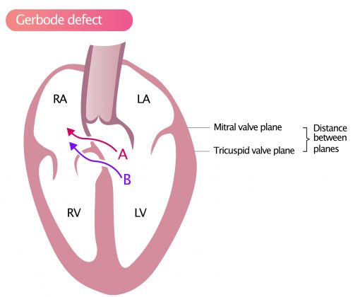 Congenital heart disease & GUCH (Grown Up Congenital Heart disease ...