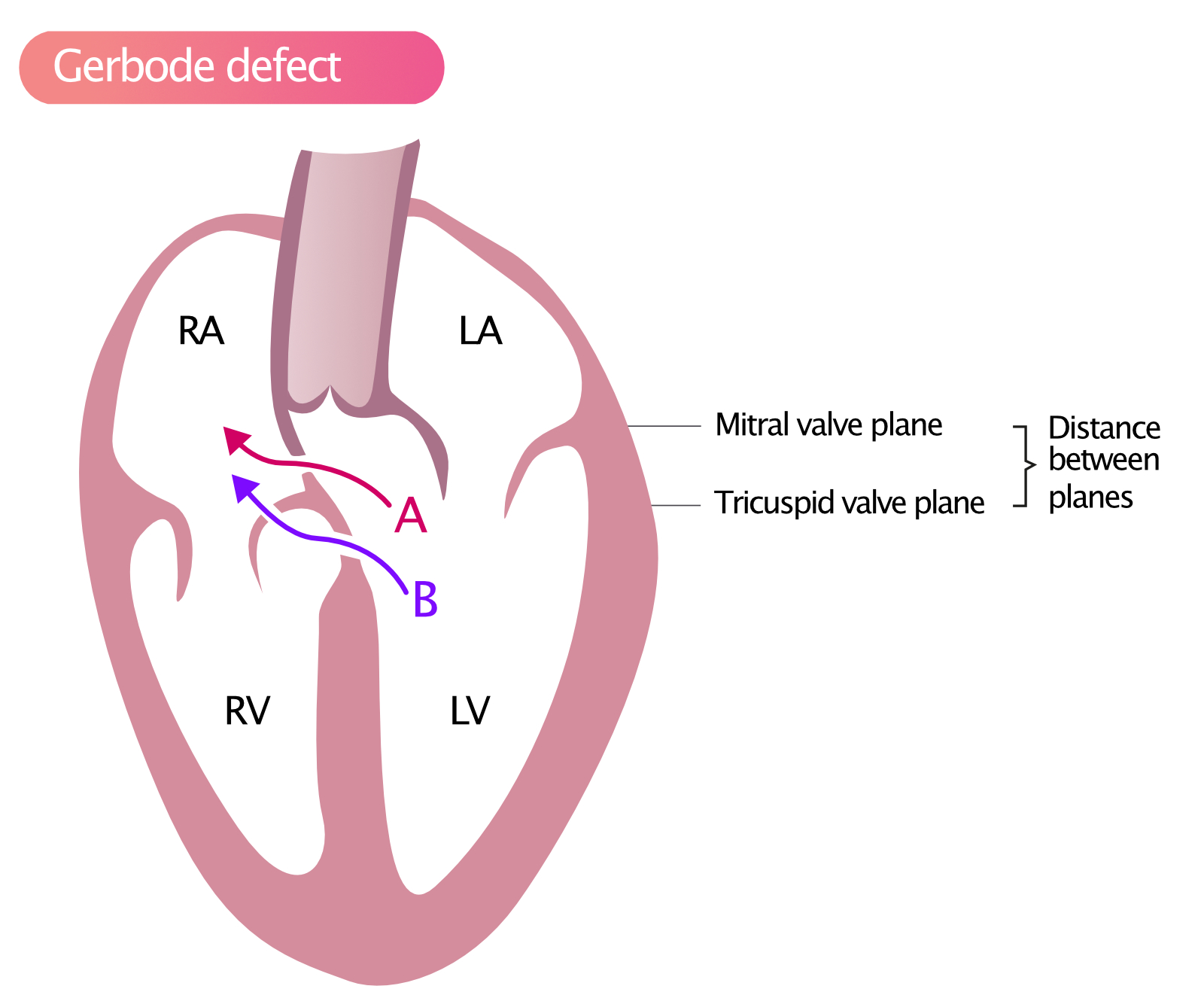 Congenital heart disease & GUCH (Grown Up Congenital Heart disease ...