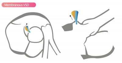 Congenital heart disease & GUCH (Grown Up Congenital Heart disease ...