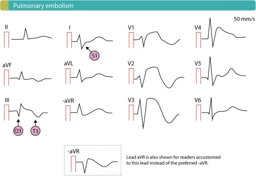 Pulmonary Embolism (PE): Causes, symptoms, diagnosis, treatment