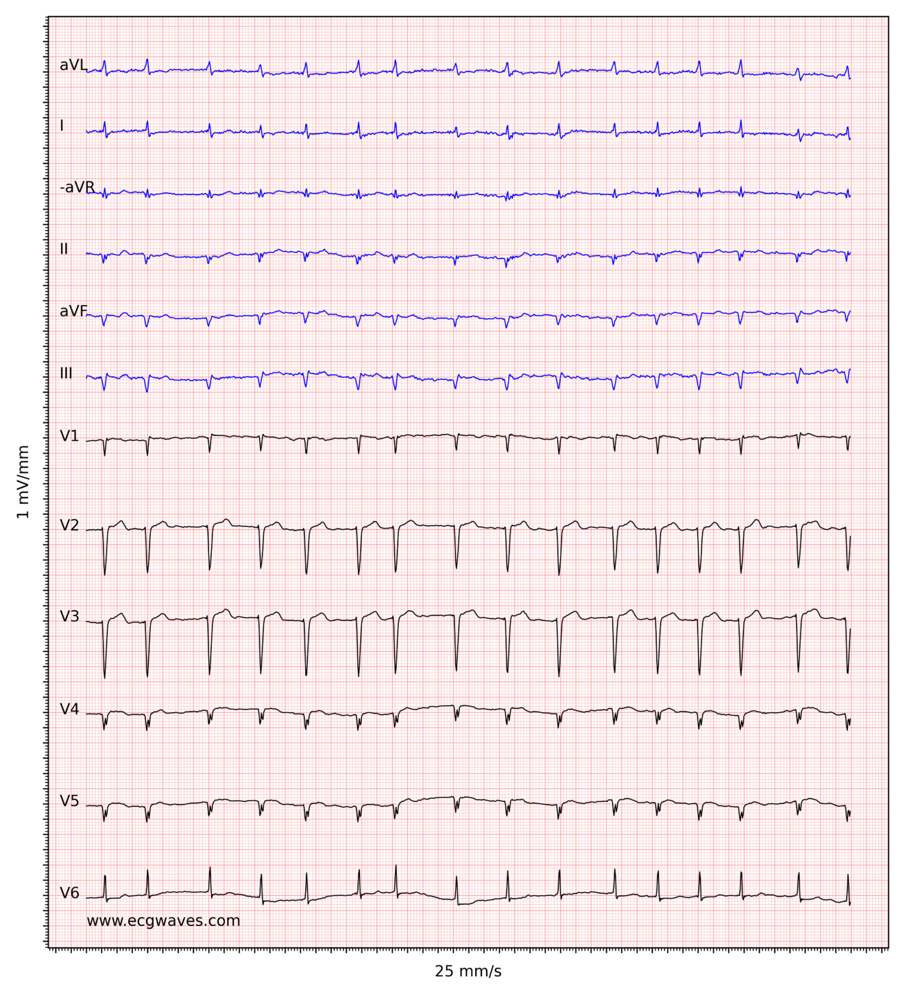 Atrial fibrillation: ECG, classification, causes, risk factors ...