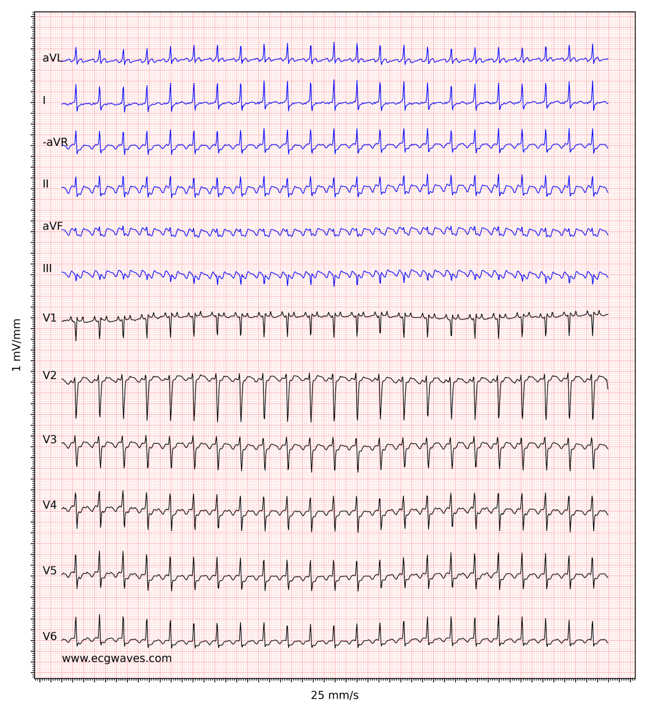 Atrial flutter: classification, causes, ECG criteria and management ...