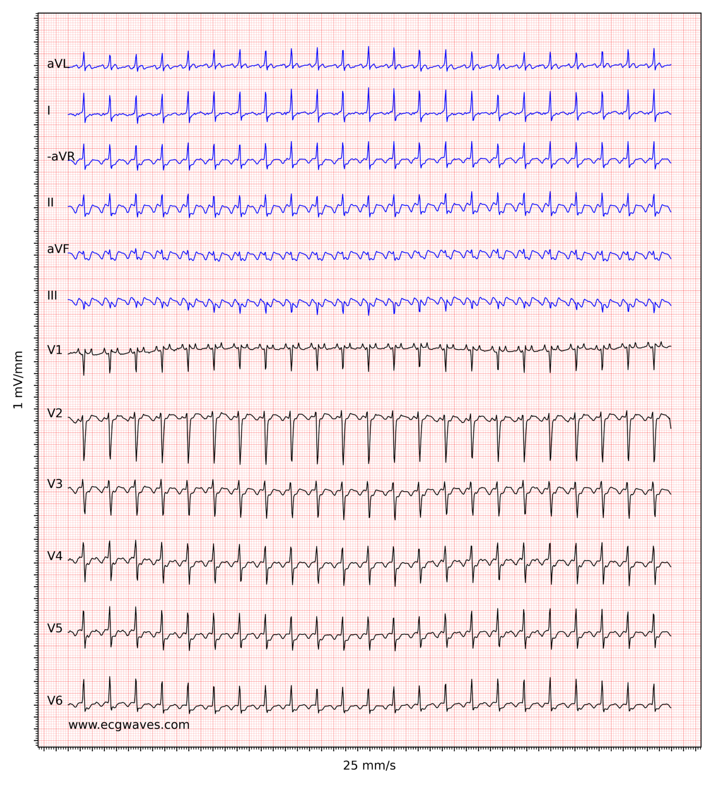 Atrial flutter: classification, causes, ECG criteria and management ...