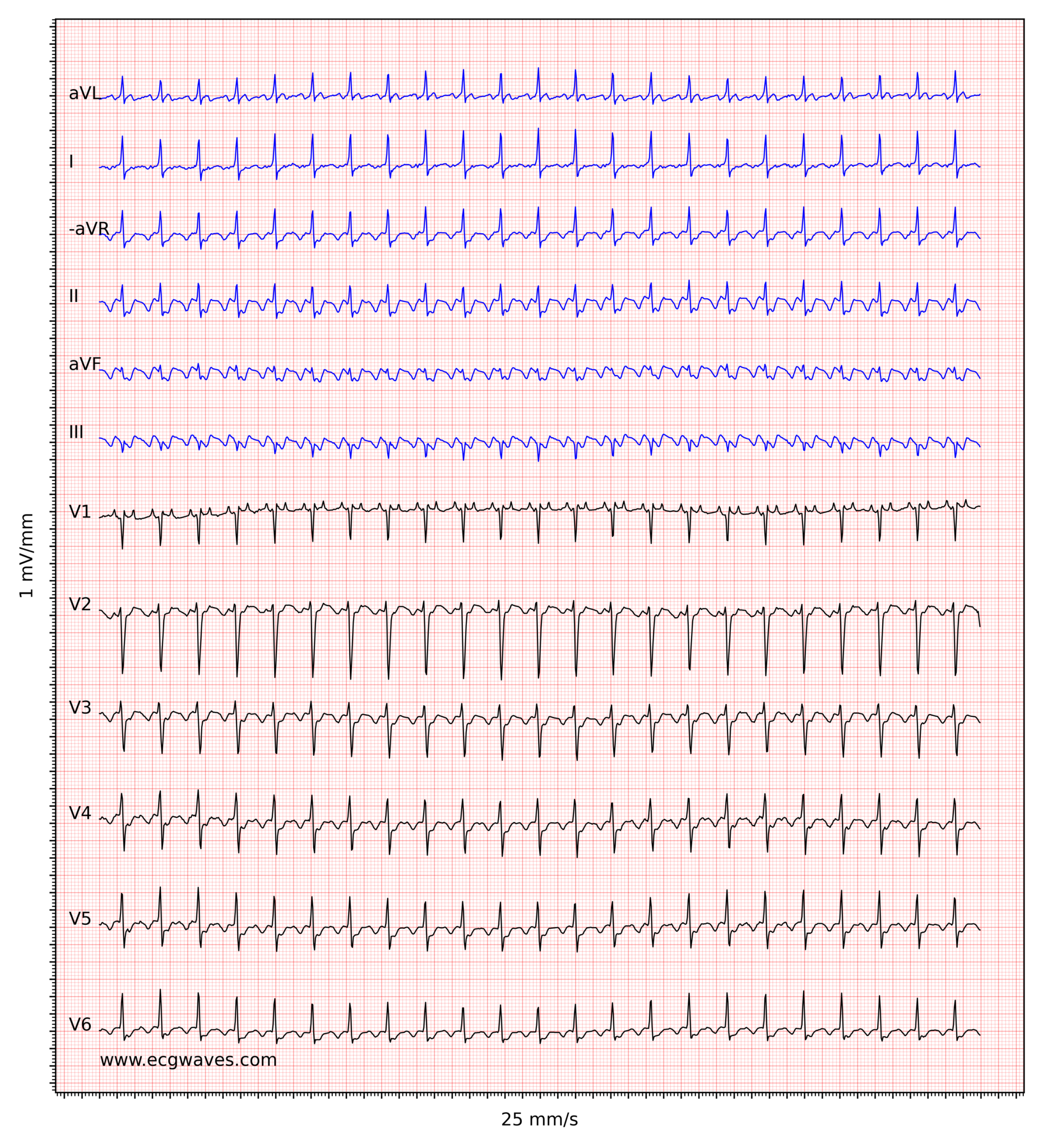 Atrial flutter: classification, causes, ECG criteria and management ...