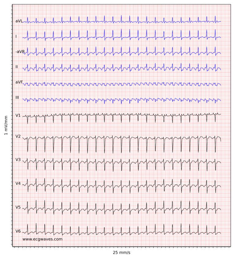 Atrial flutter: classification, causes, ECG criteria and management ...