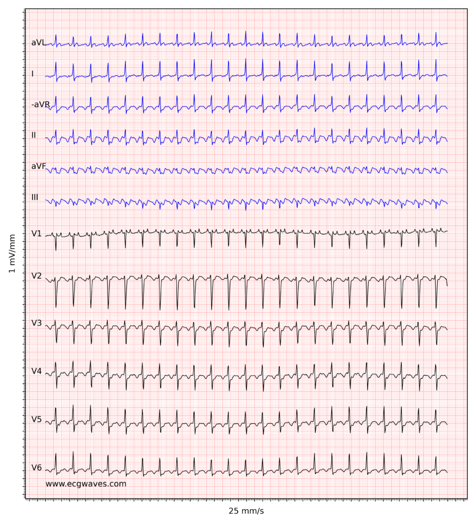 Atrial flutter: classification, causes, ECG criteria and management ...