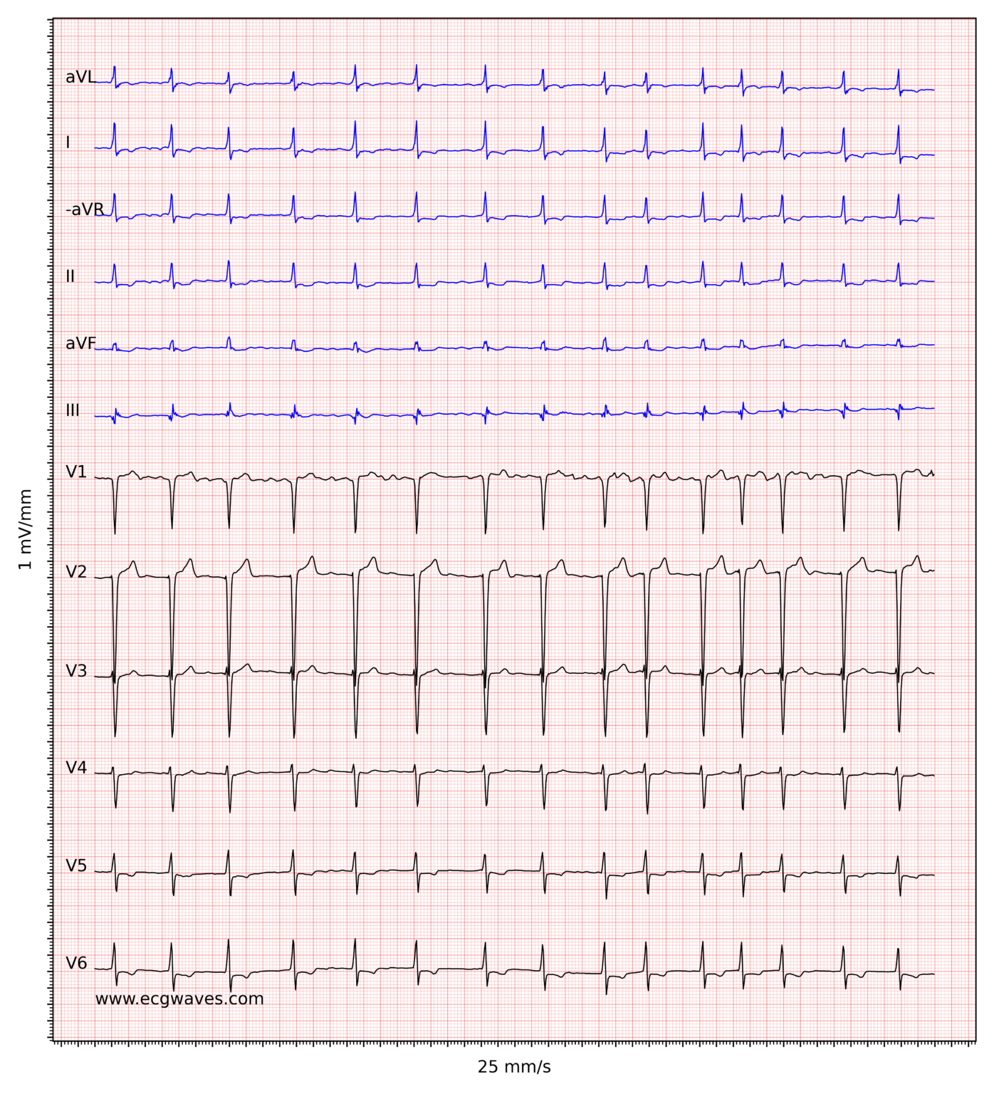 Atrial fibrillation: ECG, classification, causes, risk factors ...