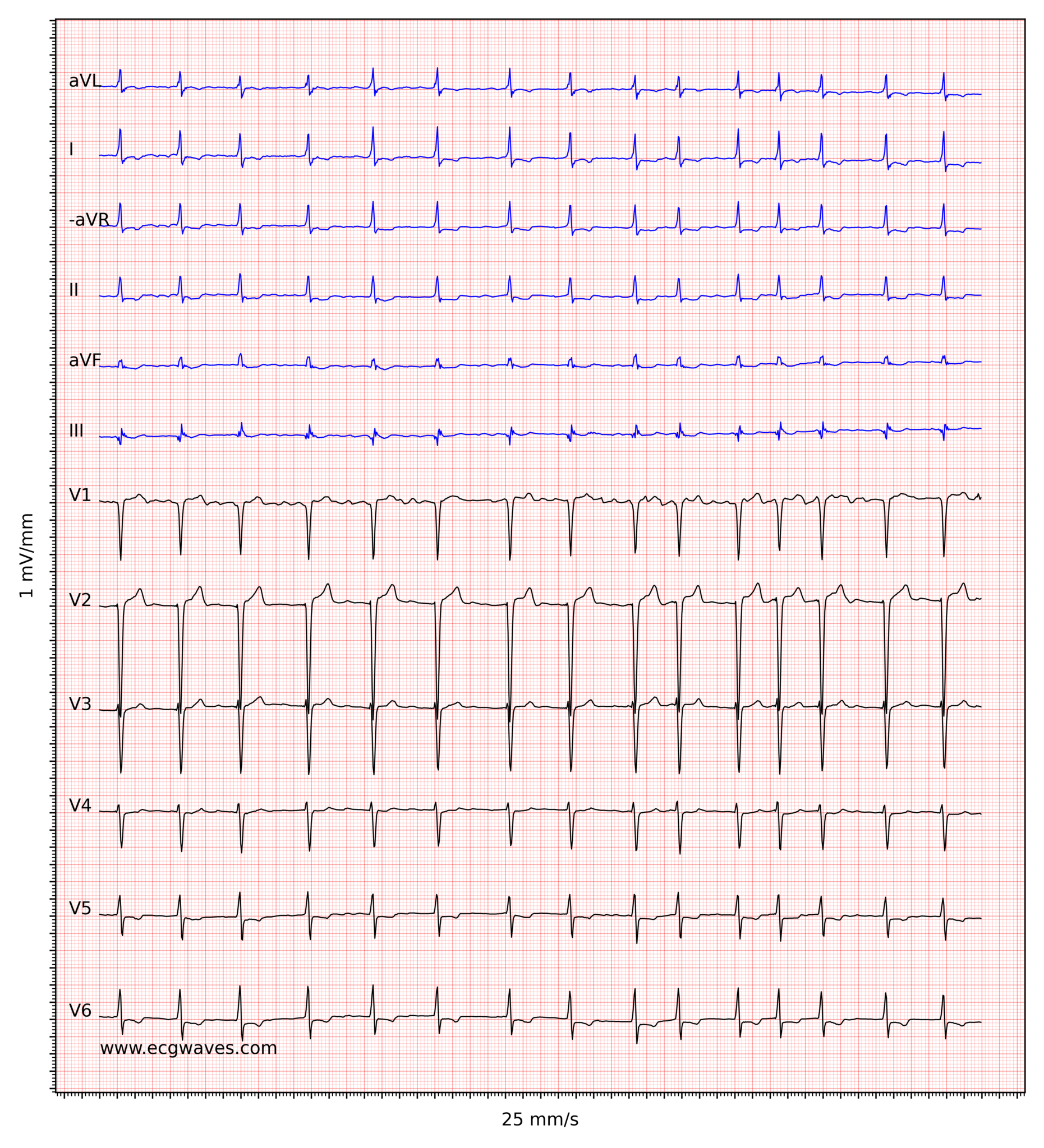 Atrial fibrillation: ECG, classification, causes, risk factors ...