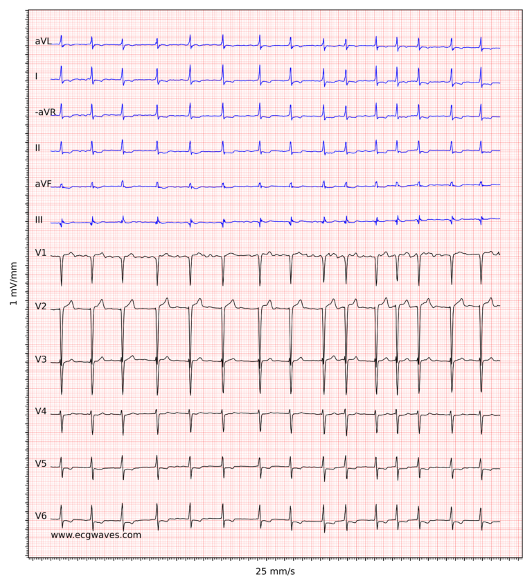 Atrial fibrillation: ECG, classification, causes, risk factors ...