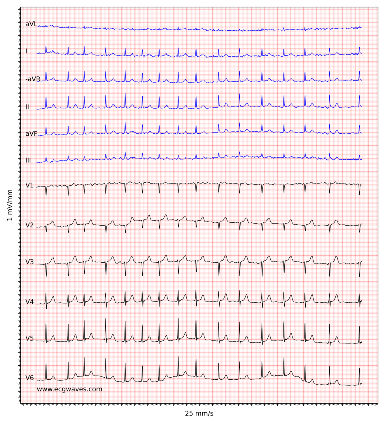 Atrial fibrillation: ECG, classification, causes, risk factors ...