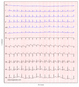 Atrial fibrillation: ECG, classification, causes, risk factors ...