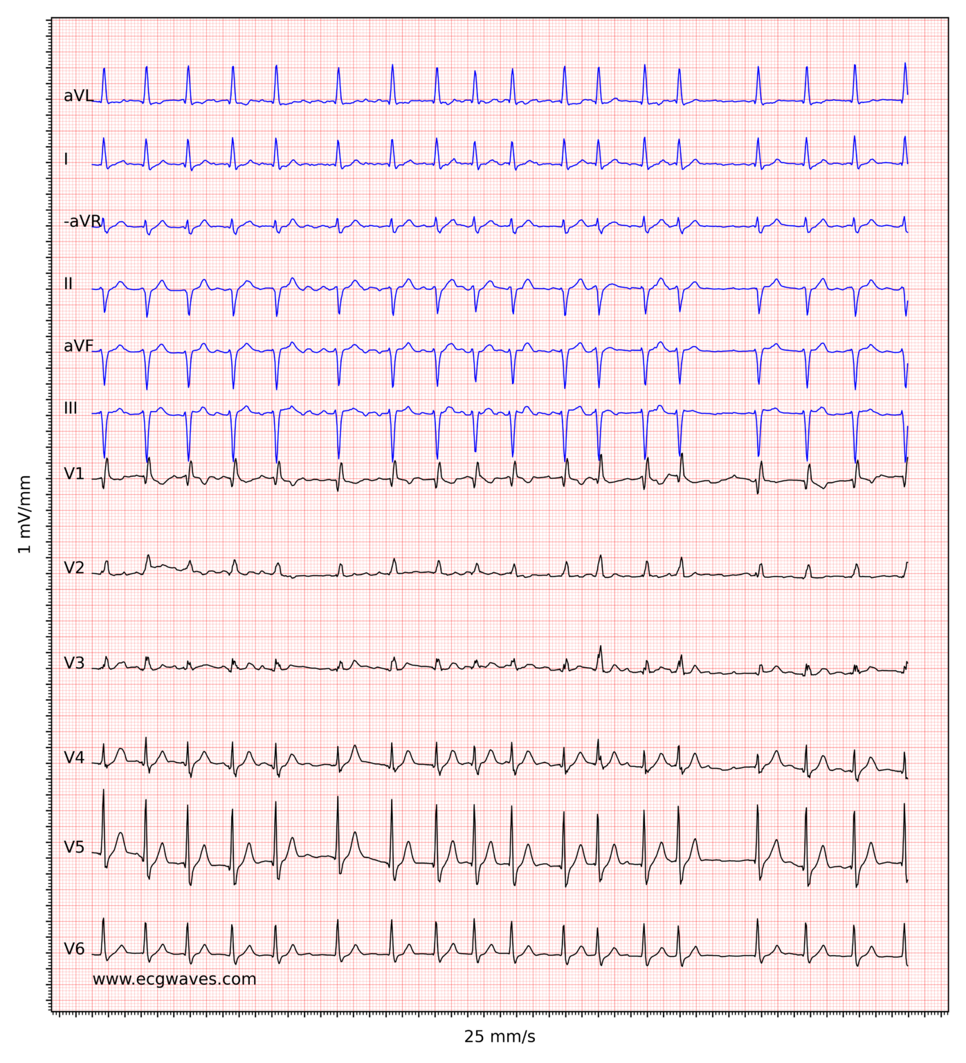 Atrial fibrillation: ECG, classification, causes, risk factors ...