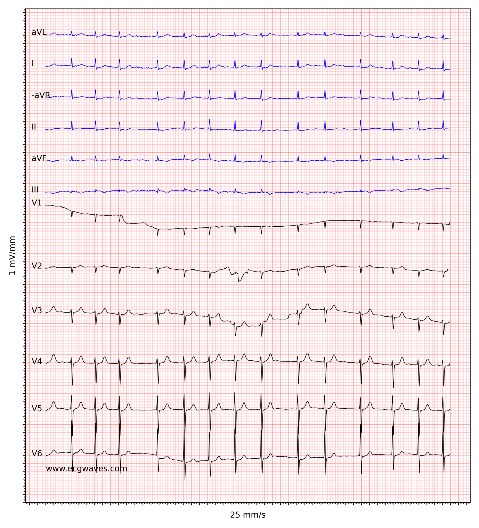 Atrial fibrillation: ECG, classification, causes, risk factors ...