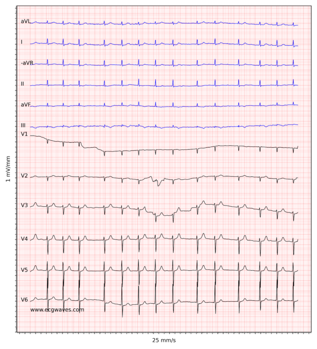 Atrial fibrillation: ECG, classification, causes, risk factors ...