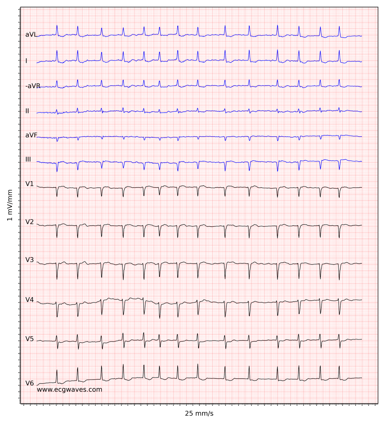 Atrial fibrillation: ECG, classification, causes, risk factors ...