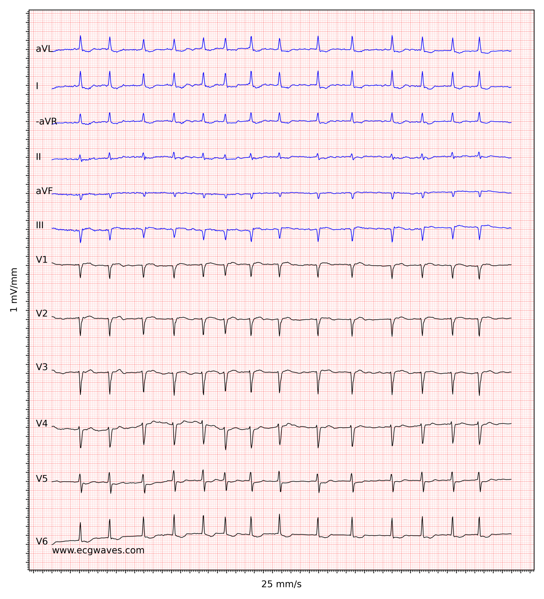 Atrial fibrillation: ECG, classification, causes, risk factors ...