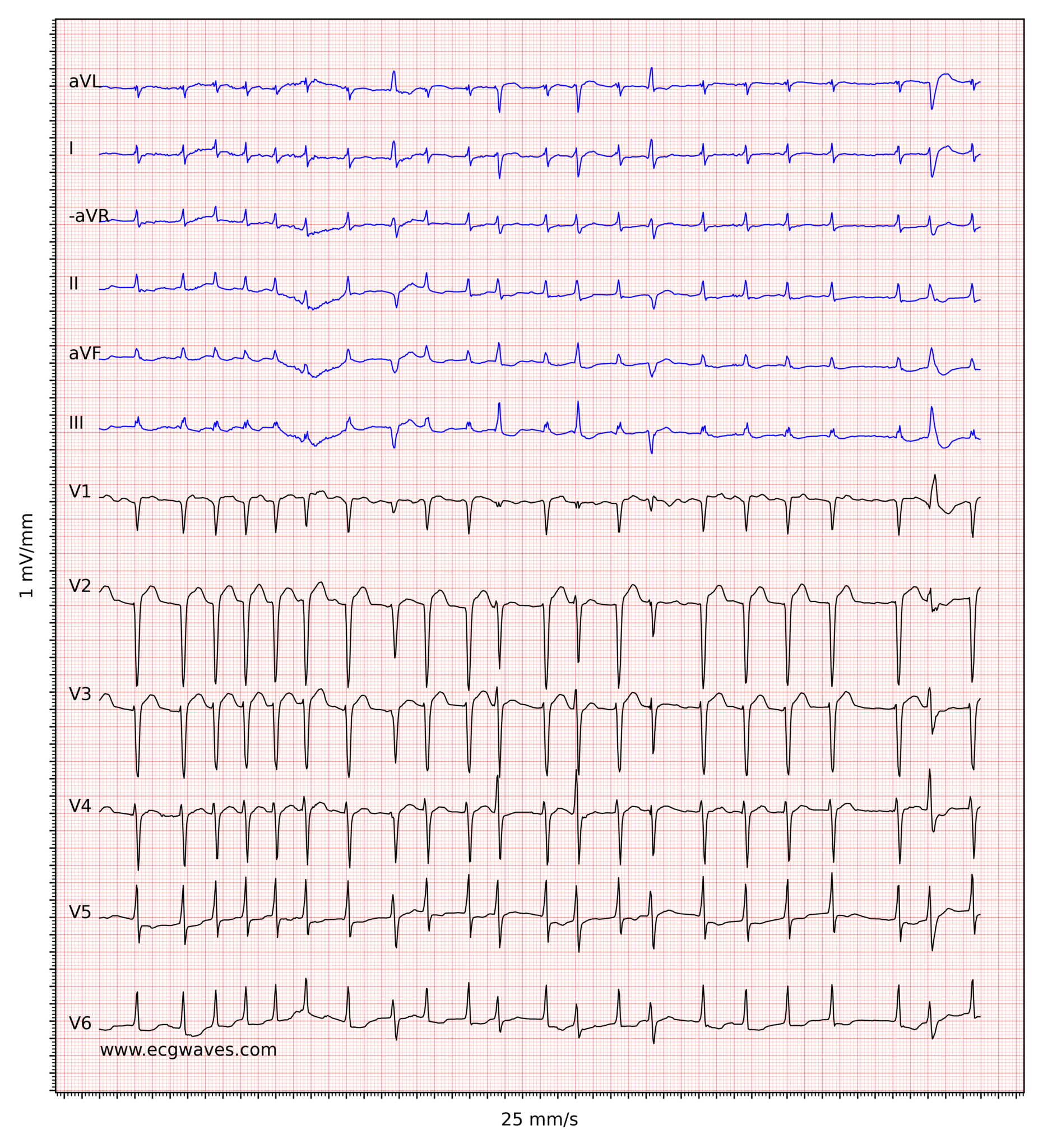 Atrial fibrillation: ECG, classification, causes, risk factors ...