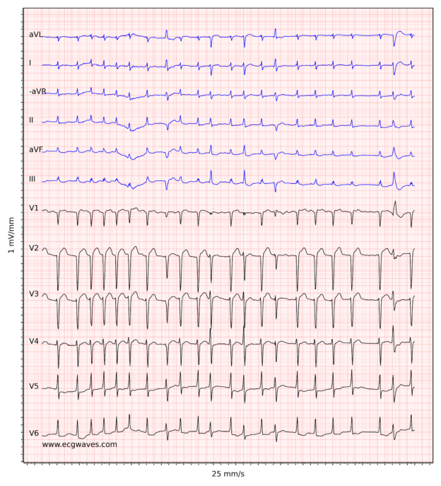 Atrial fibrillation: ECG, classification, causes, risk factors ...