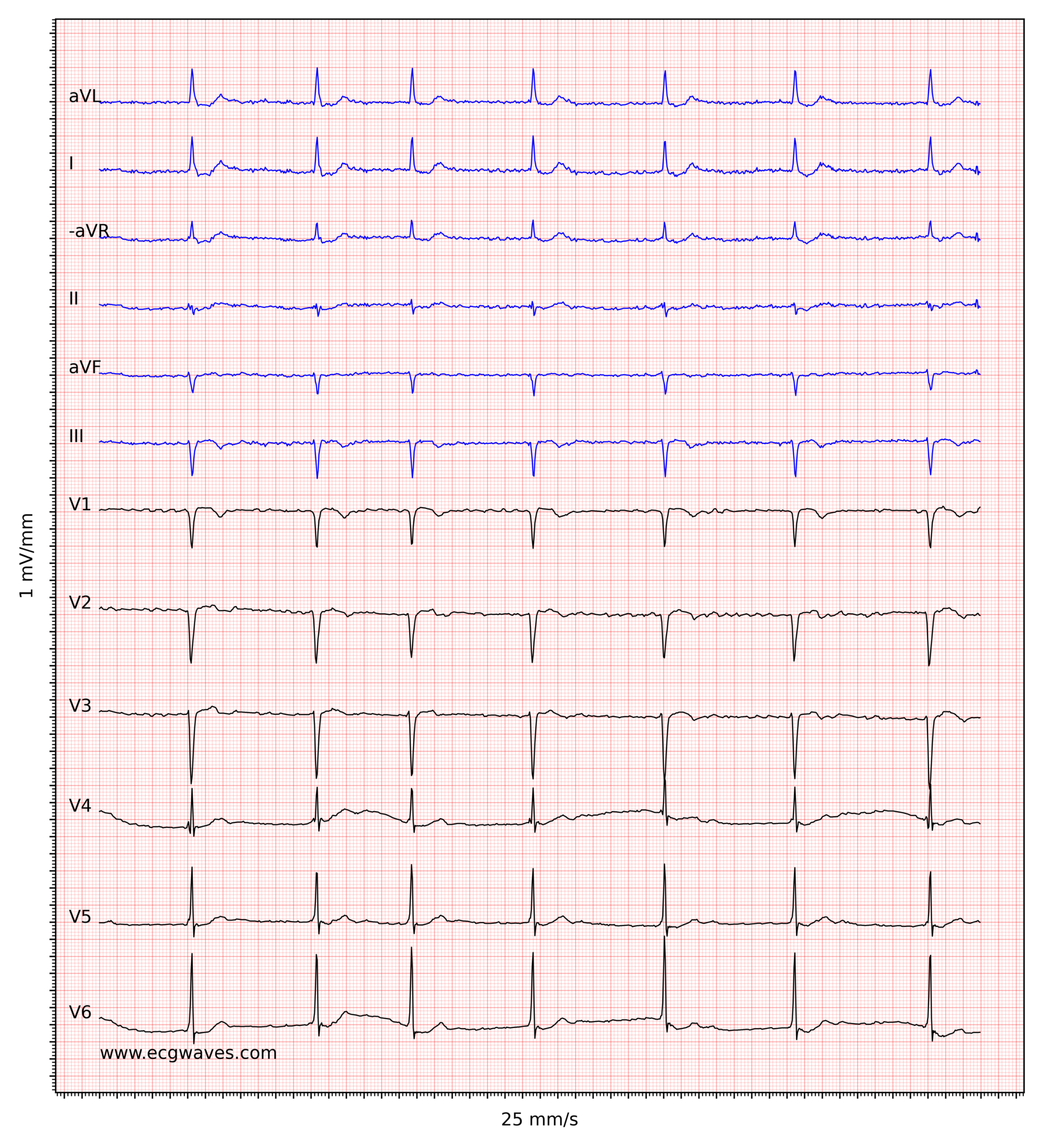 Atrial fibrillation: ECG, classification, causes, risk factors ...
