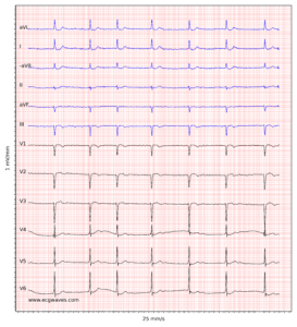 Atrial fibrillation: ECG, classification, causes, risk factors ...