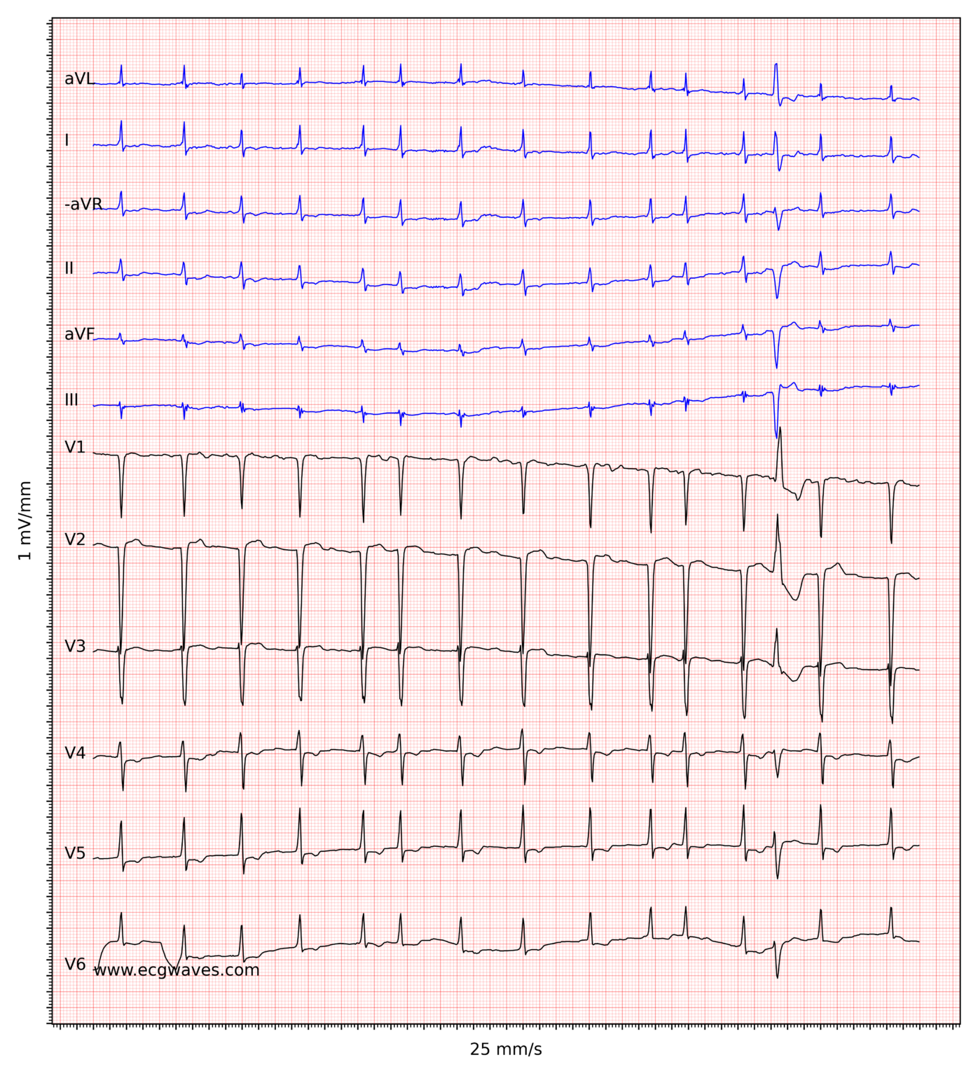 Atrial fibrillation: ECG, classification, causes, risk factors ...