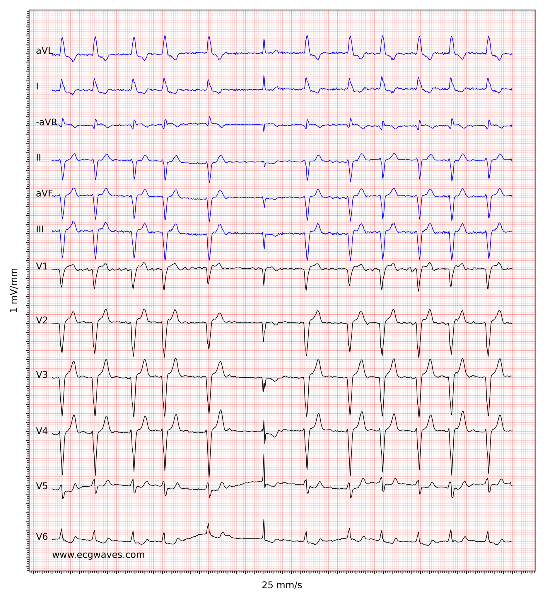 Atrial fibrillation: ECG, classification, causes, risk factors ...