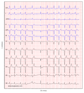 Atrial fibrillation: ECG, classification, causes, risk factors ...
