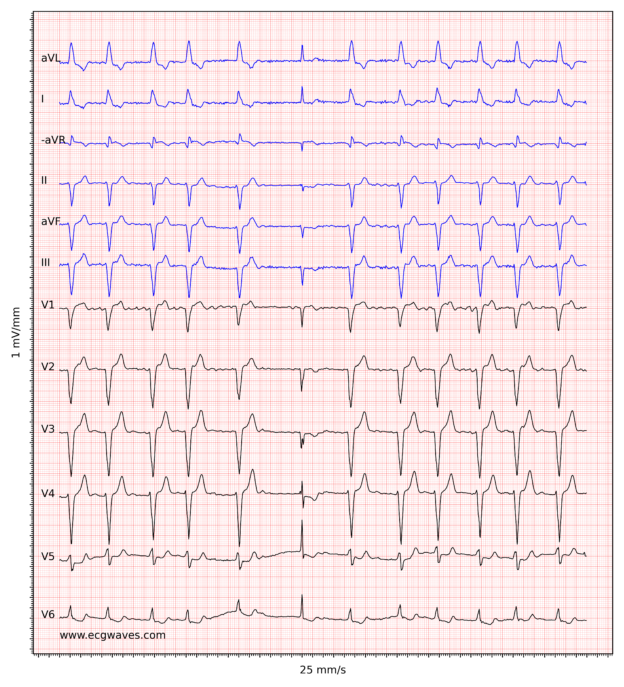 Atrial fibrillation: ECG, classification, causes, risk factors ...