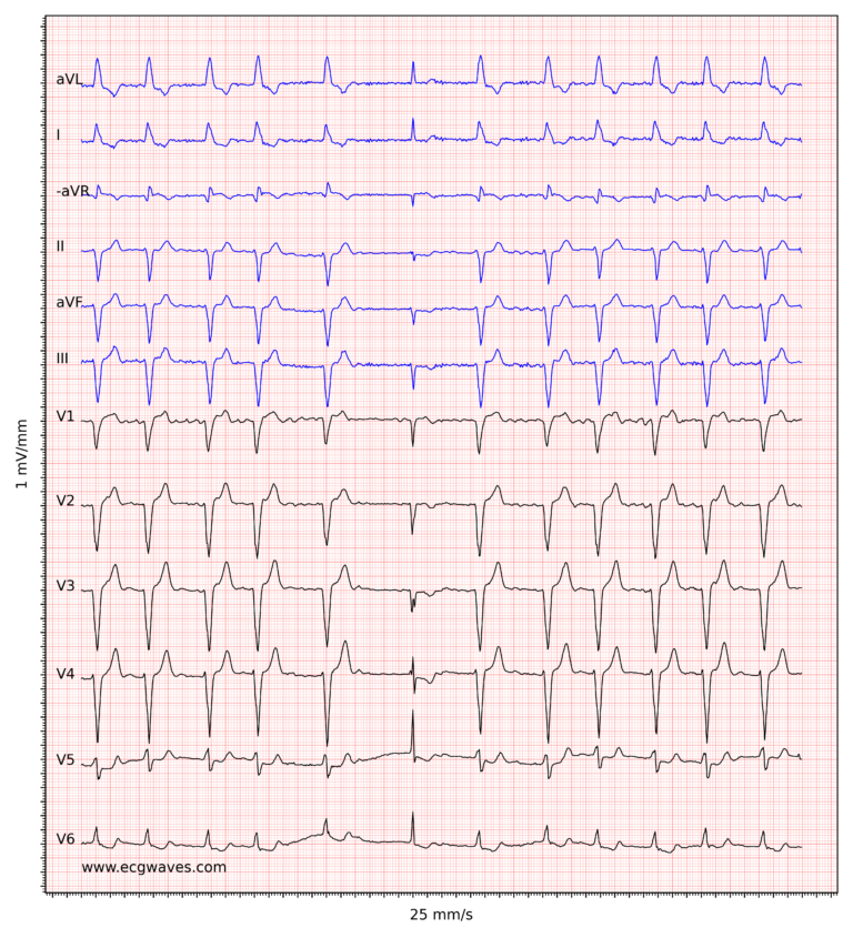 Atrial fibrillation: ECG, classification, causes, risk factors ...