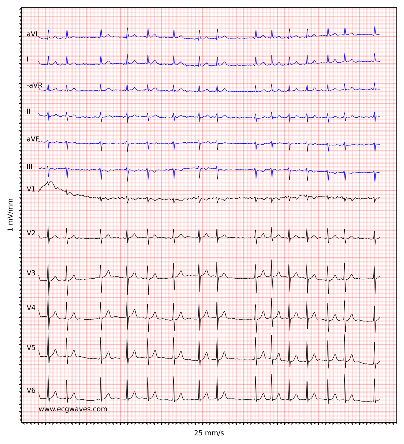 Atrial fibrillation: ECG, classification, causes, risk factors ...