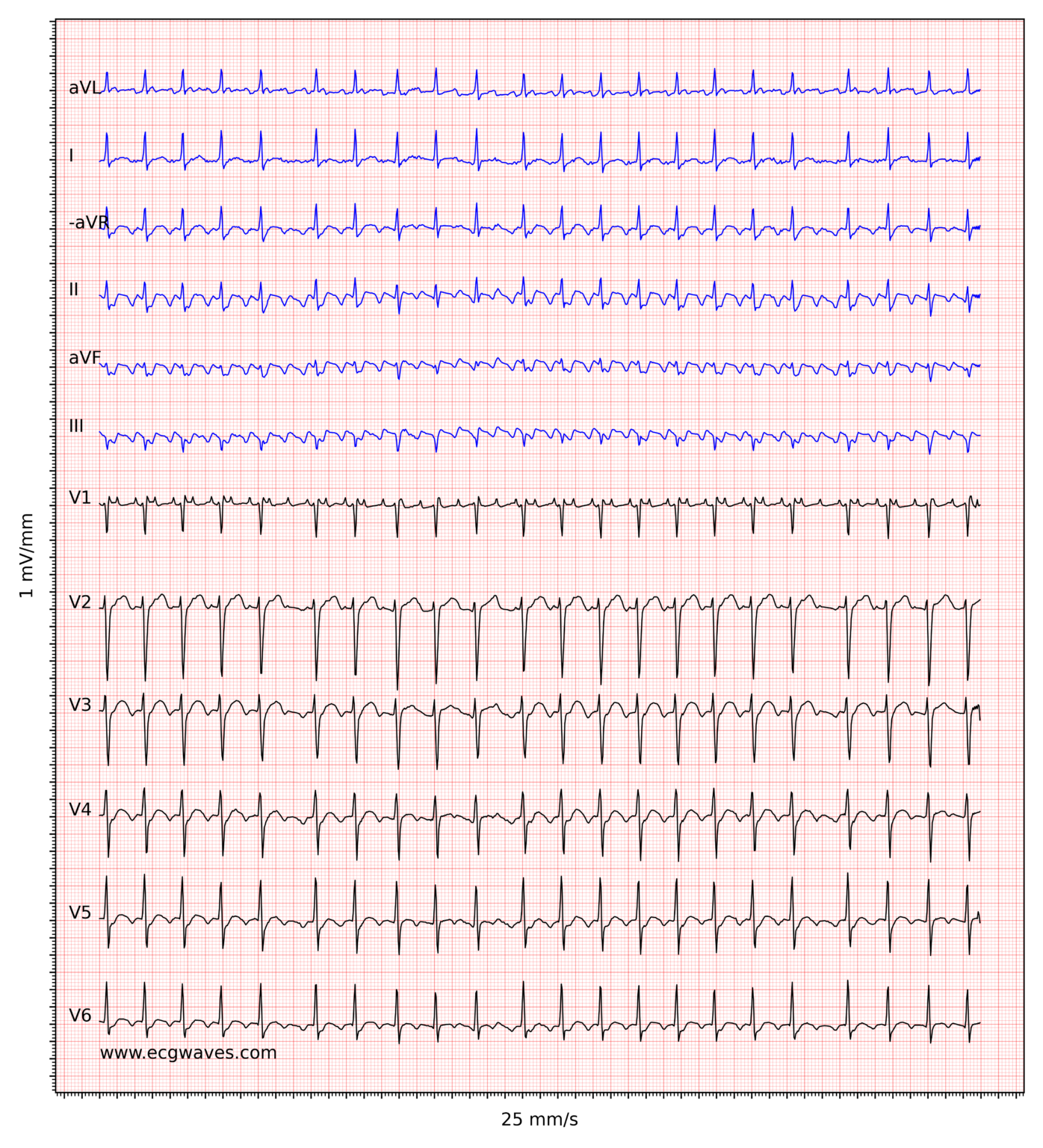 Atrial flutter: classification, causes, ECG criteria and management ...