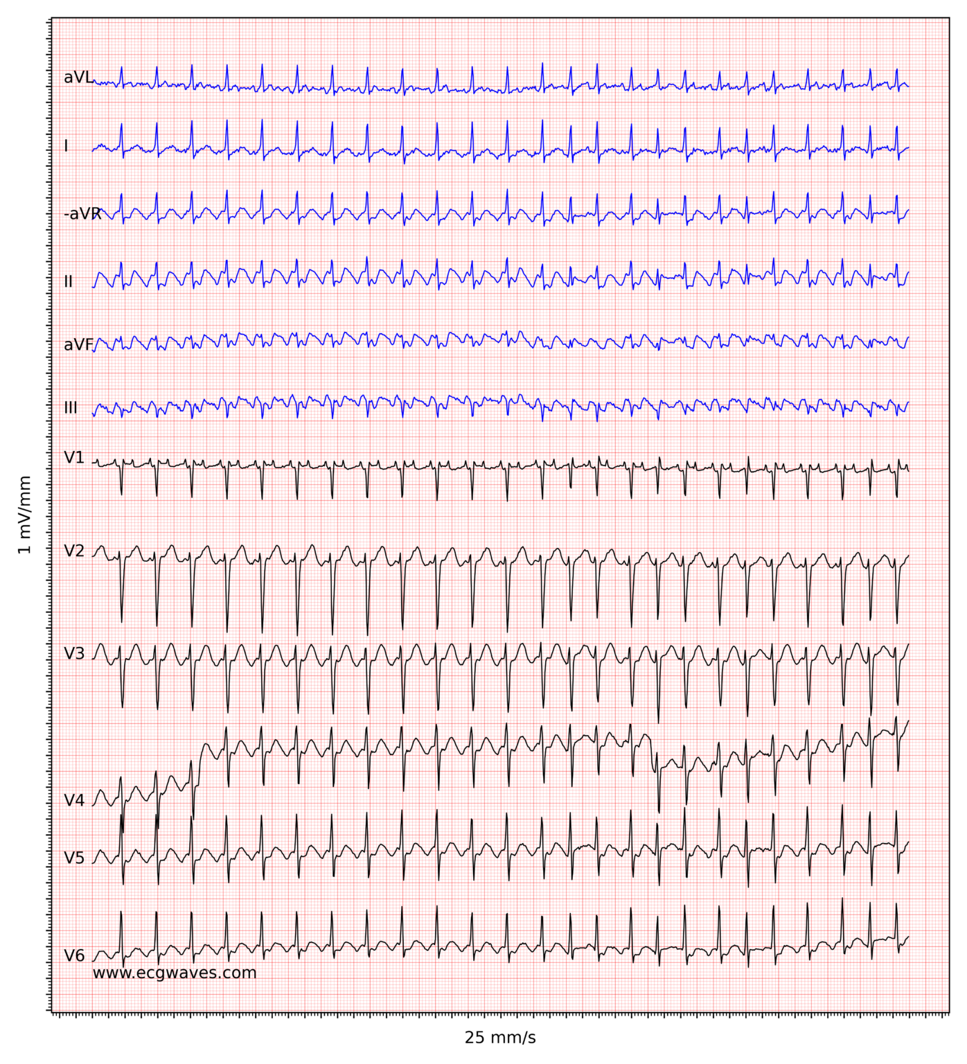 Atrial Flutter Classification Causes Ecg Criteria And Management The Cardiovascular