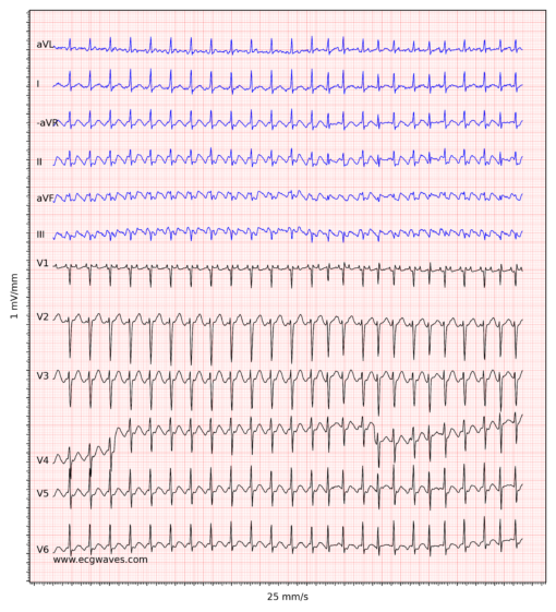 Atrial flutter: classification, causes, ECG criteria and management ...