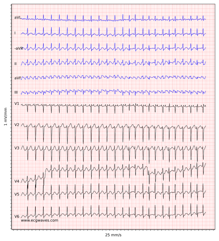 Atrial flutter: classification, causes, ECG criteria and management ...