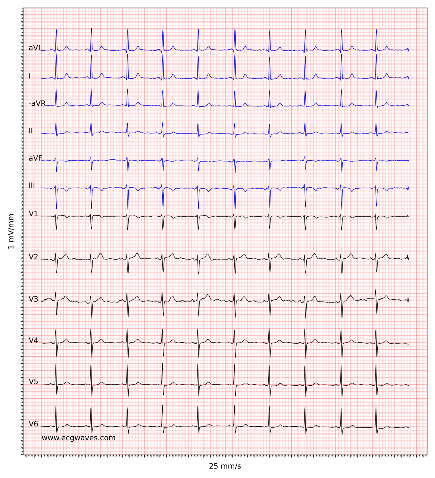 ECG interpretation: Characteristics of the normal ECG (P-wave, QRS ...