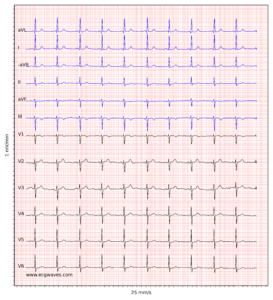 ECG interpretation: Characteristics of the normal ECG (P-wave, QRS ...