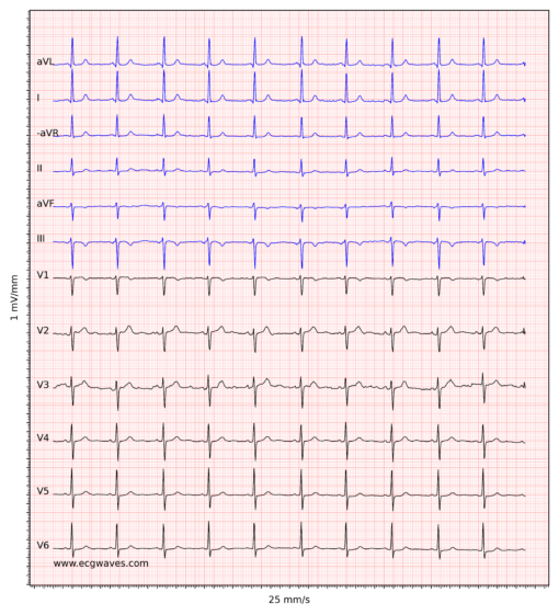 ECG interpretation: Characteristics of the normal ECG (P-wave, QRS ...