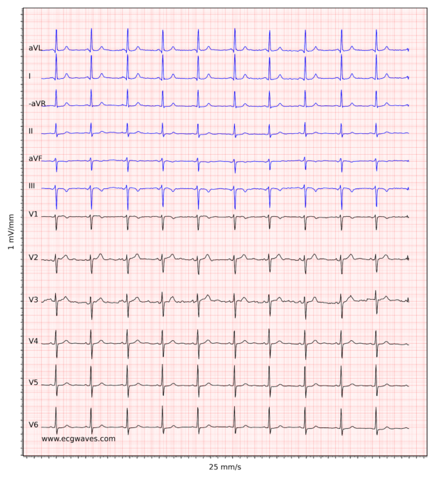 ECG interpretation: Characteristics of the normal ECG (P-wave, QRS ...