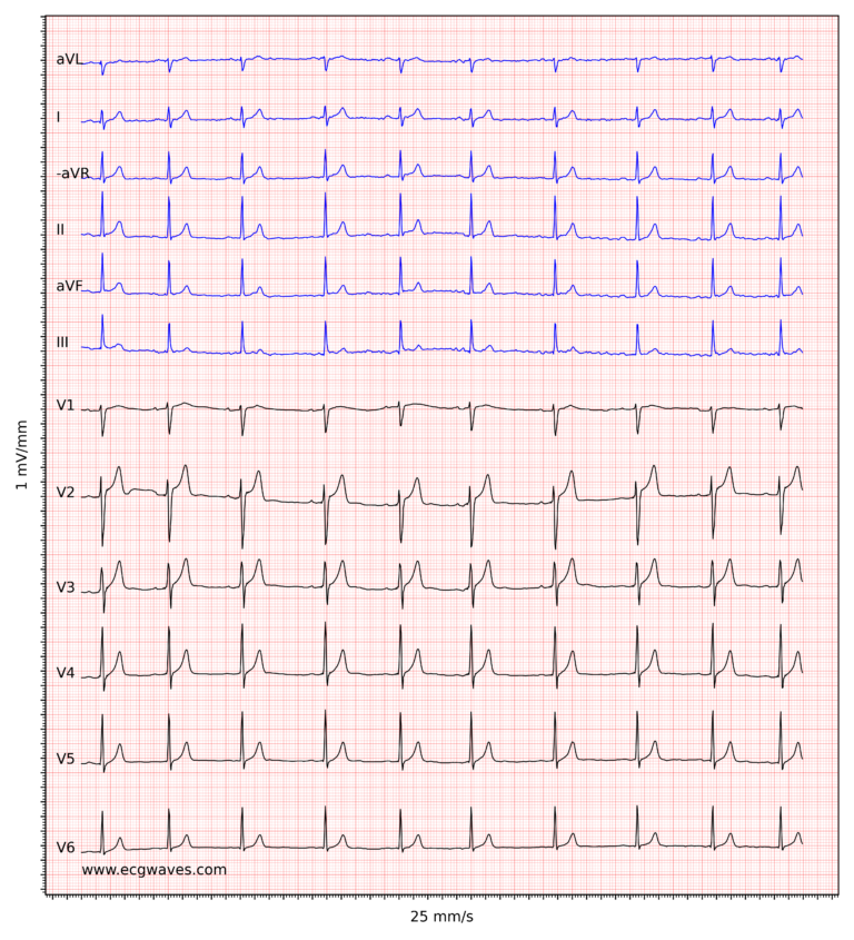 ECG interpretation: Characteristics of the normal ECG (P-wave, QRS ...