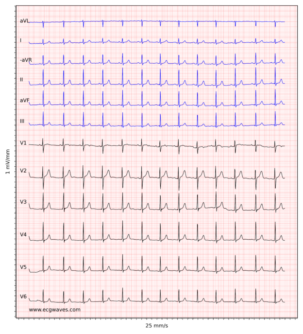 ECG interpretation: Characteristics of the normal ECG (P-wave, QRS ...