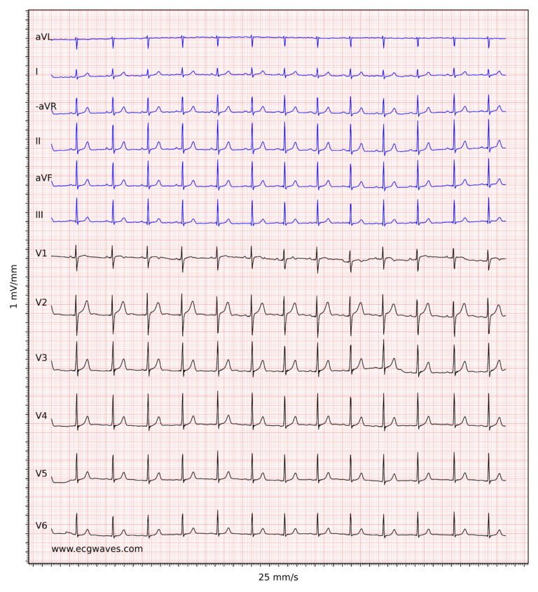 ECG interpretation: Characteristics of the normal ECG (P-wave, QRS ...