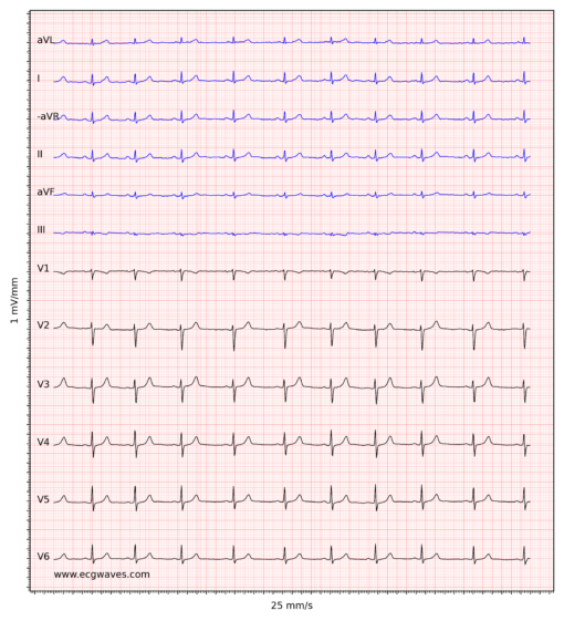 ECG interpretation: Characteristics of the normal ECG (P-wave, QRS ...