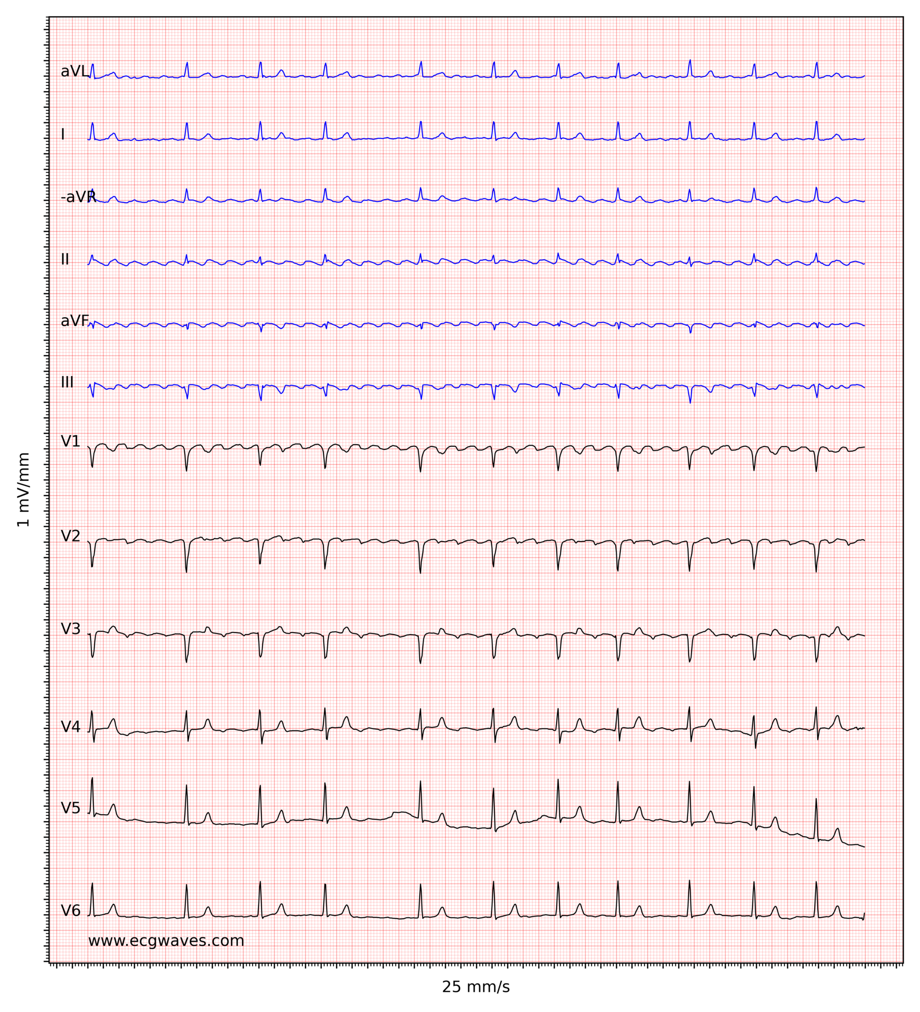 Atrial Flutter Classification Causes Ecg Criteria And Management