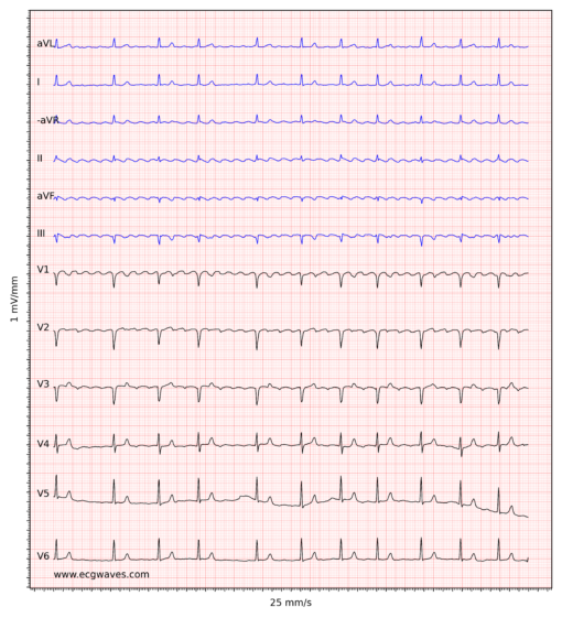 Atrial Flutter Classification Causes Ecg Criteria And Management The Cardiovascular