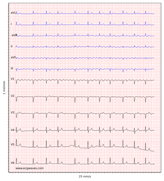 Atrial flutter: classification, causes, ECG criteria and management ...